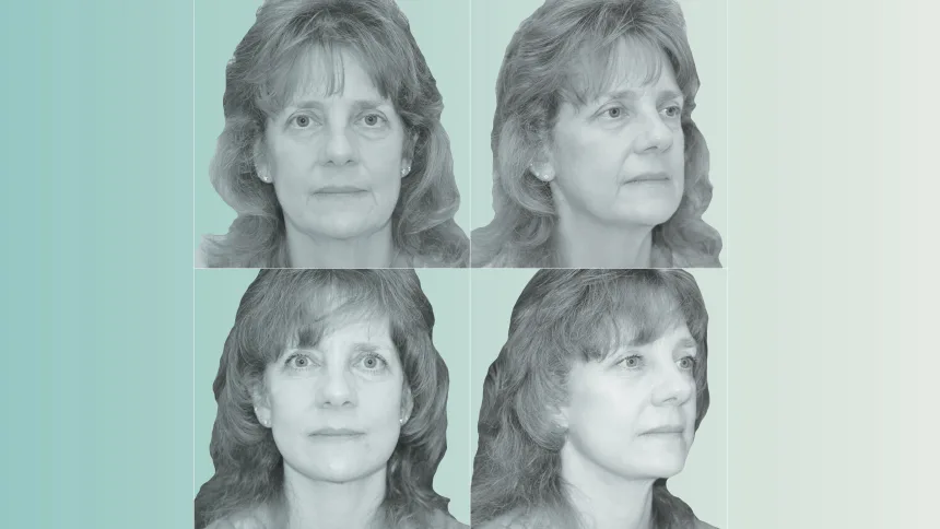 Ozempic Face Exposed: The Surprising Side Effect That No One Warned You ...